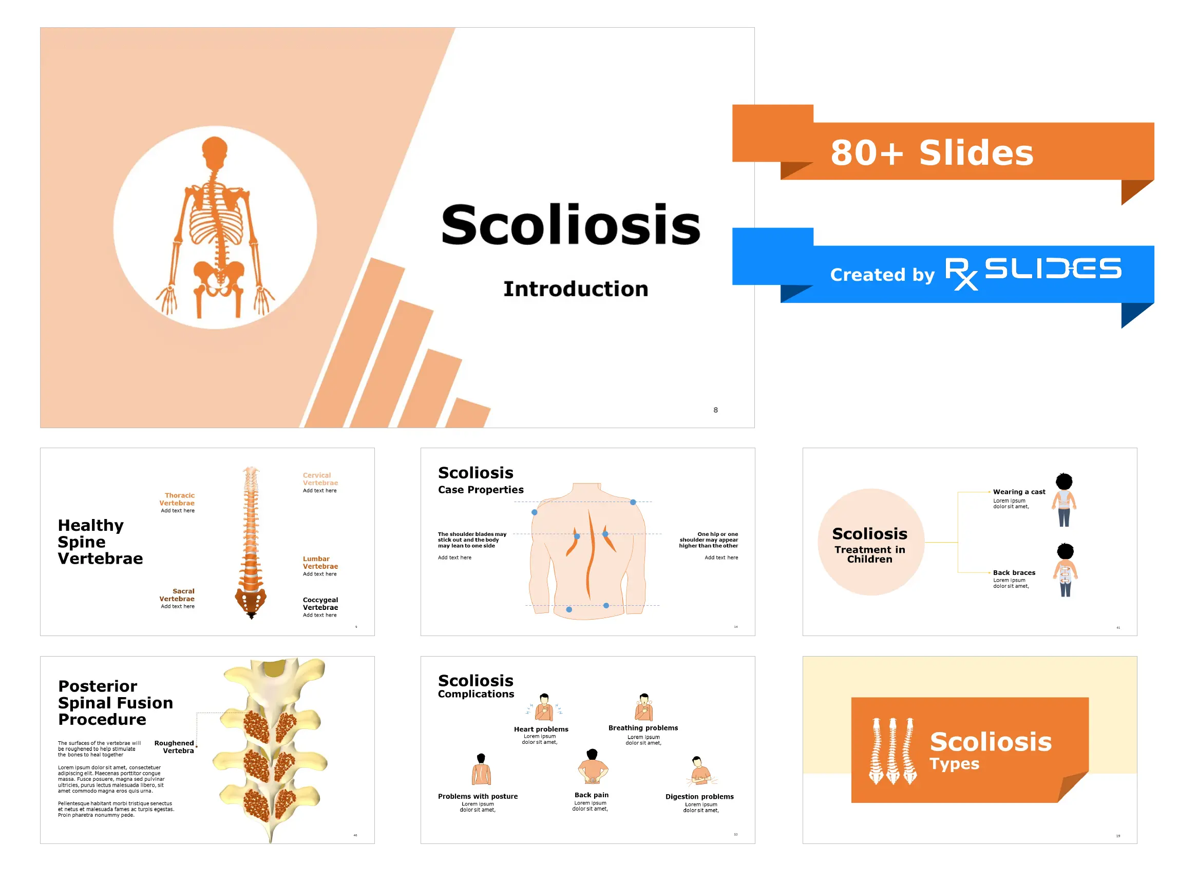 Download Scoliosis PowerPoint Template| RxSlides